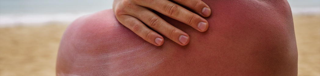 Sunburn Sos Quick Relief And Prevention Tips The Skin People Dermatology